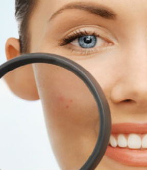 Noda Hitam Di Wajah? Ini Cara Mengatasinya - Beauty Journal