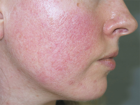 Rosacea - Beauty Journal
