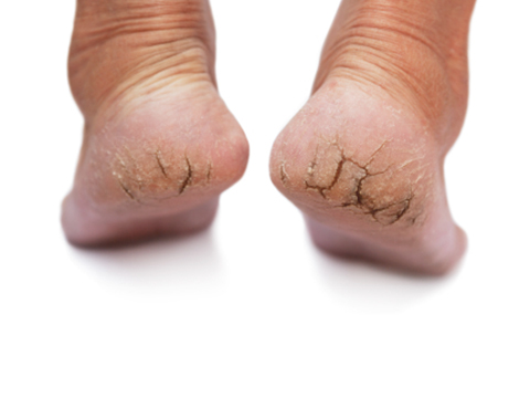 Anhidrosis - Beauty Journal