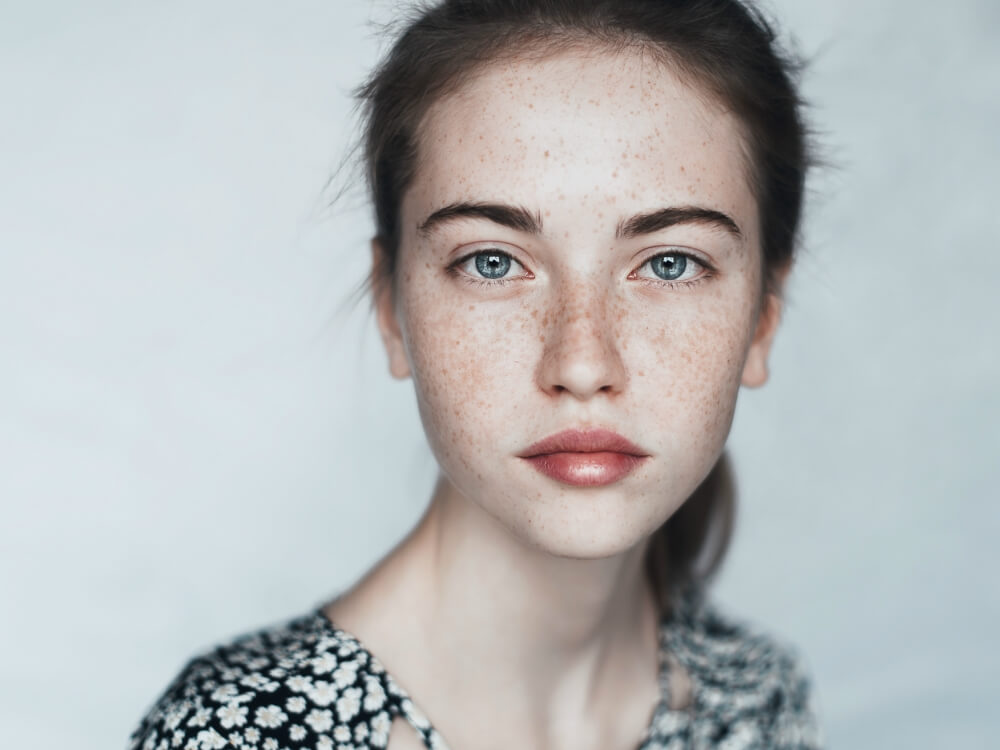 5 Fakta Tentang Freckles yang Perlu Anda Ketahui - Beauty Journal