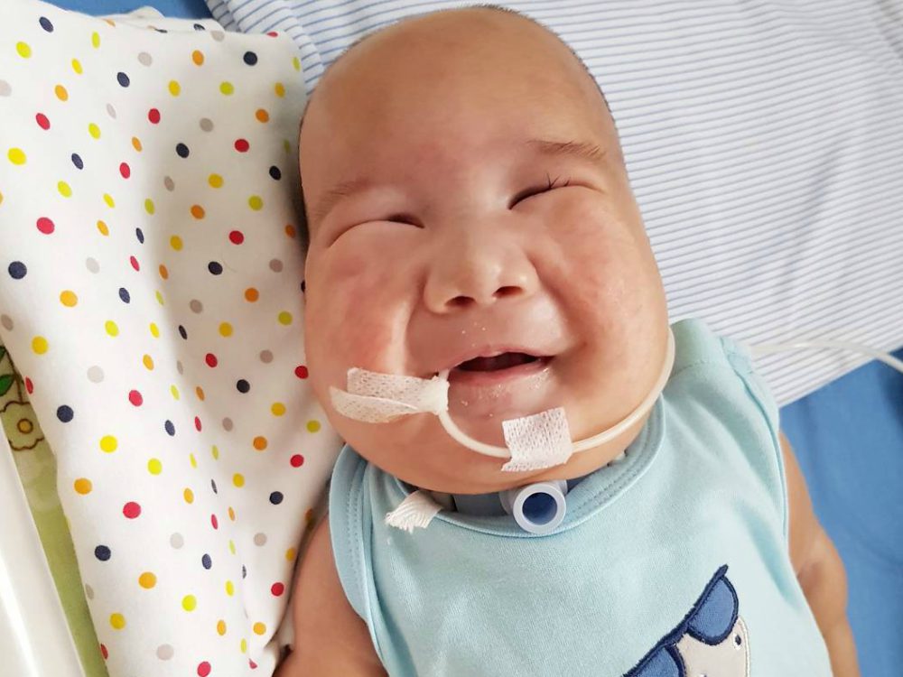 Mengenal Trisomy 13, Kelainan Kromosom Langka yang Membuat Bayi Adam ...
