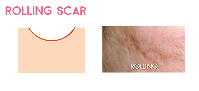 5 Jenis Bekas Jerawat yang Perlu Anda Kenali - Beauty Journal