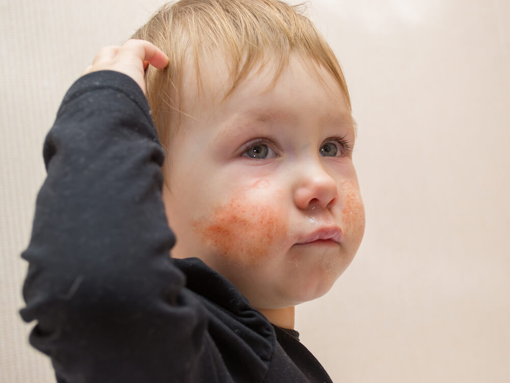 Mulai dari Gejala hingga Cara Penanganan, Berikut Hal yang Perlu Anda ...