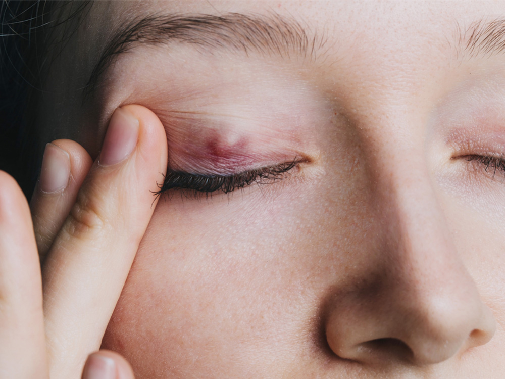 Berbagai Penyebab Bisul dan Cara yang Benar dalam Mengatasinya - Beauty ...