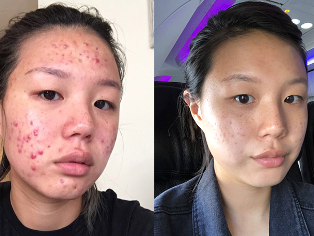 Hana Lee, Youtuber Korea yang Berhasil Mengatasi Jerawat di Wajahnya ...