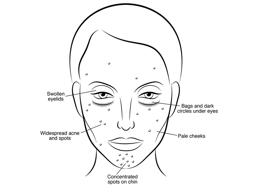 Sugar Face dan Dairy Face, Kondisi Kulit Wajah yang Disebabkan oleh ...